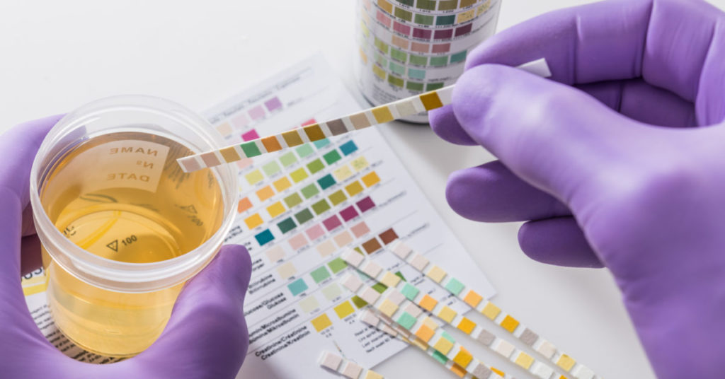 Prostate cancer: Noninvasive urine test moves an action more detailed ...
