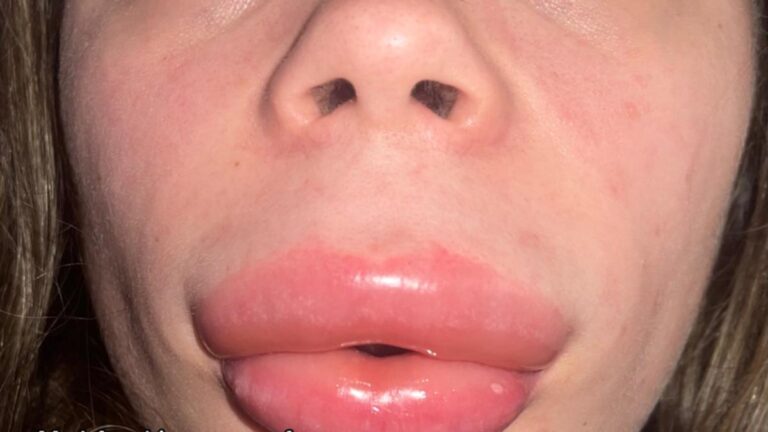 Lip filler failed: Woman shocks with scary image after ‘worst ...